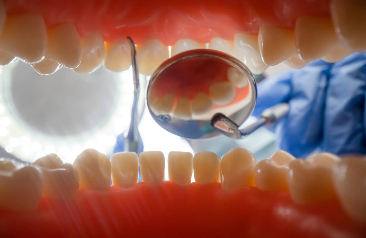 ¿Qué es el torus mandibular? | DentalQuality