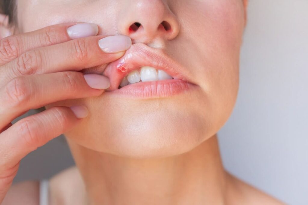 ¿Qué es la estomatitis y cómo se trata? Síntomas, causas y tipos ...